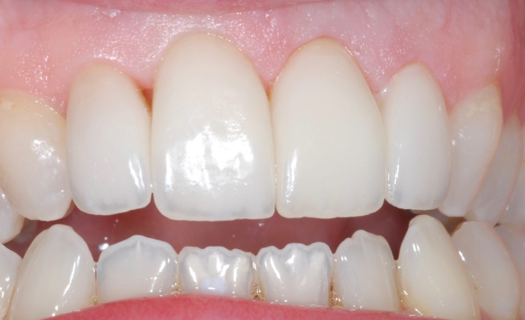 veneer-bite-problem-x-4-after - Beacon Sleep Medicine Clinic
