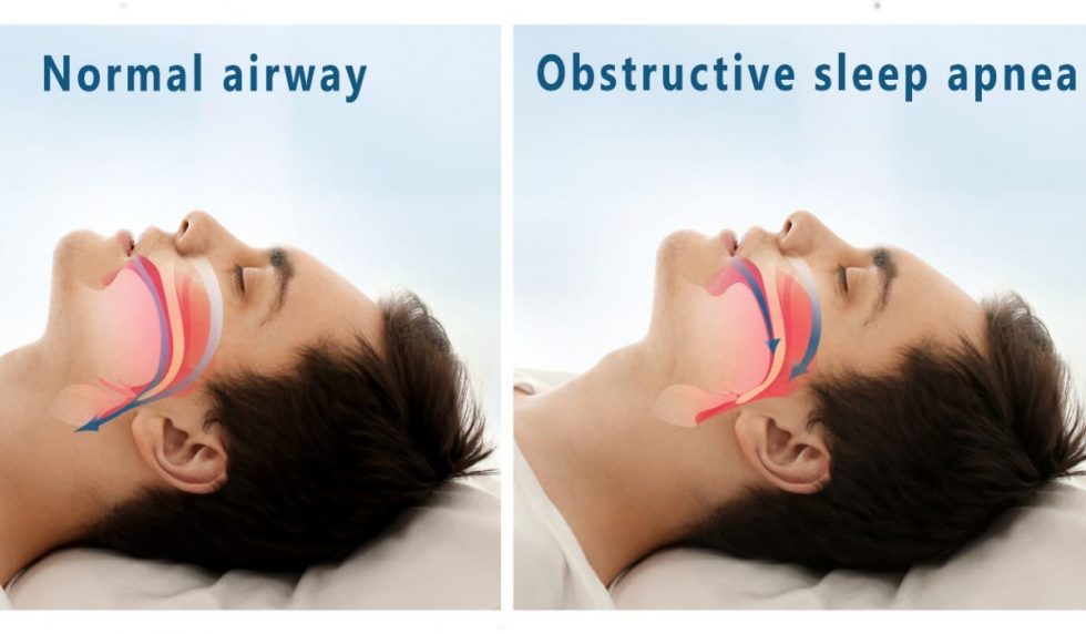 What’s the unusual reason behind your partner’s sleep-shattering snoring?