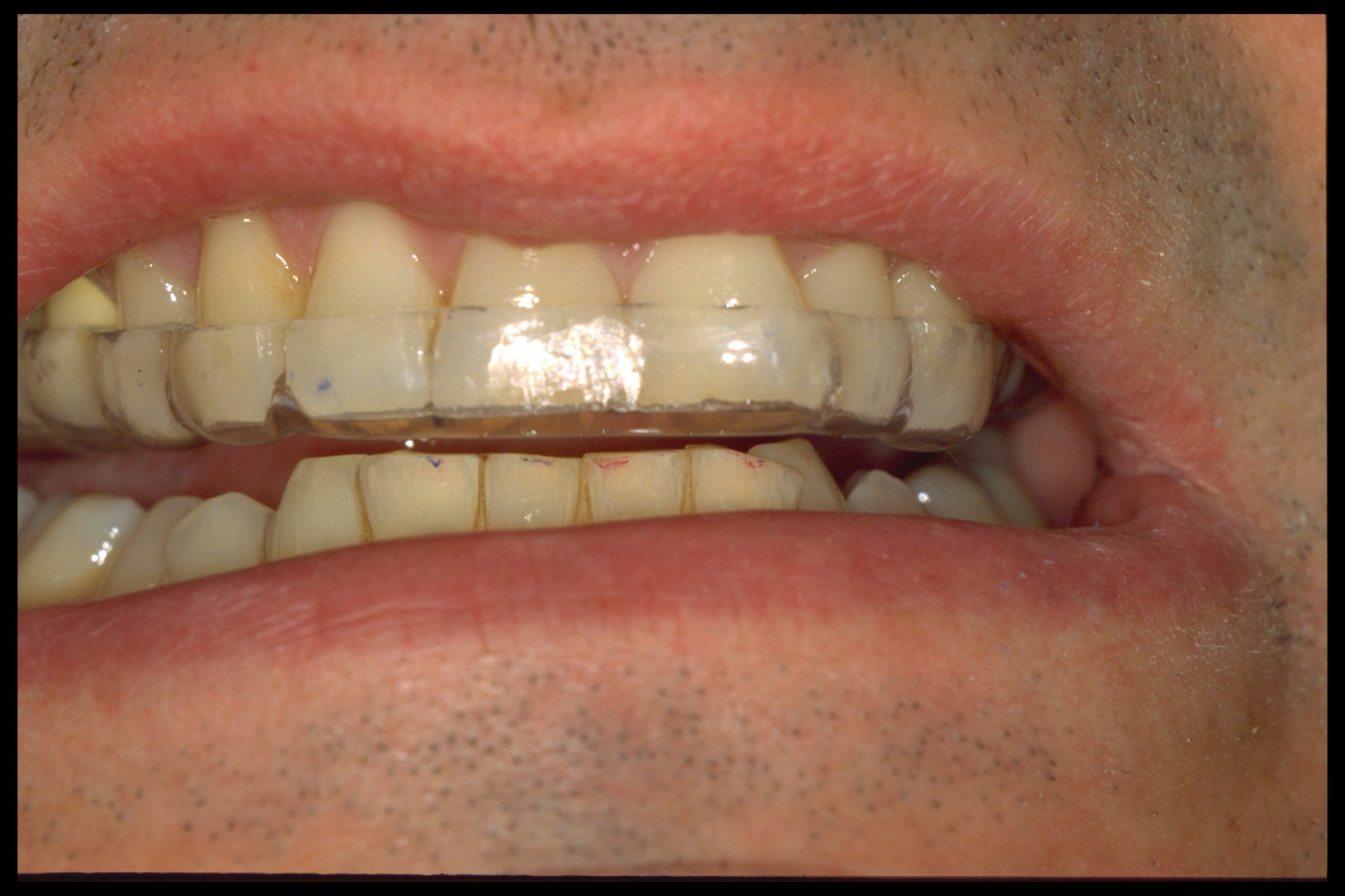 Sleep Bruxism Treatment Dublin, Grinding Teeth Treatment